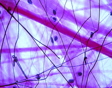 Fibrotic Disease Research Using Dermal Fibroblasts