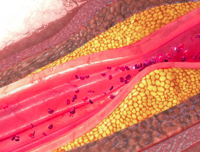 Periodontitis and Angiogenesis Research